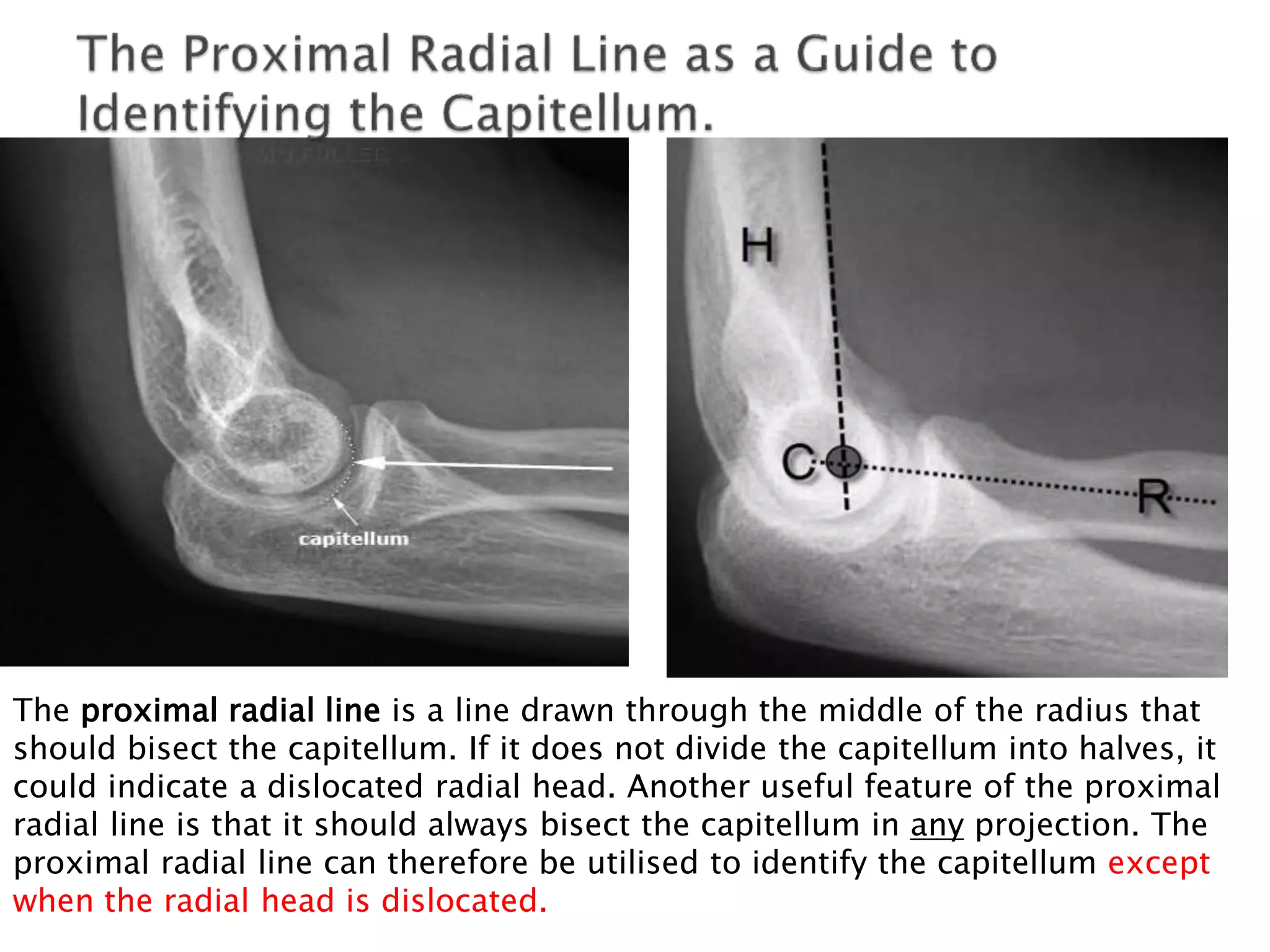 Fractures of the distal humerus ppt | PPTX