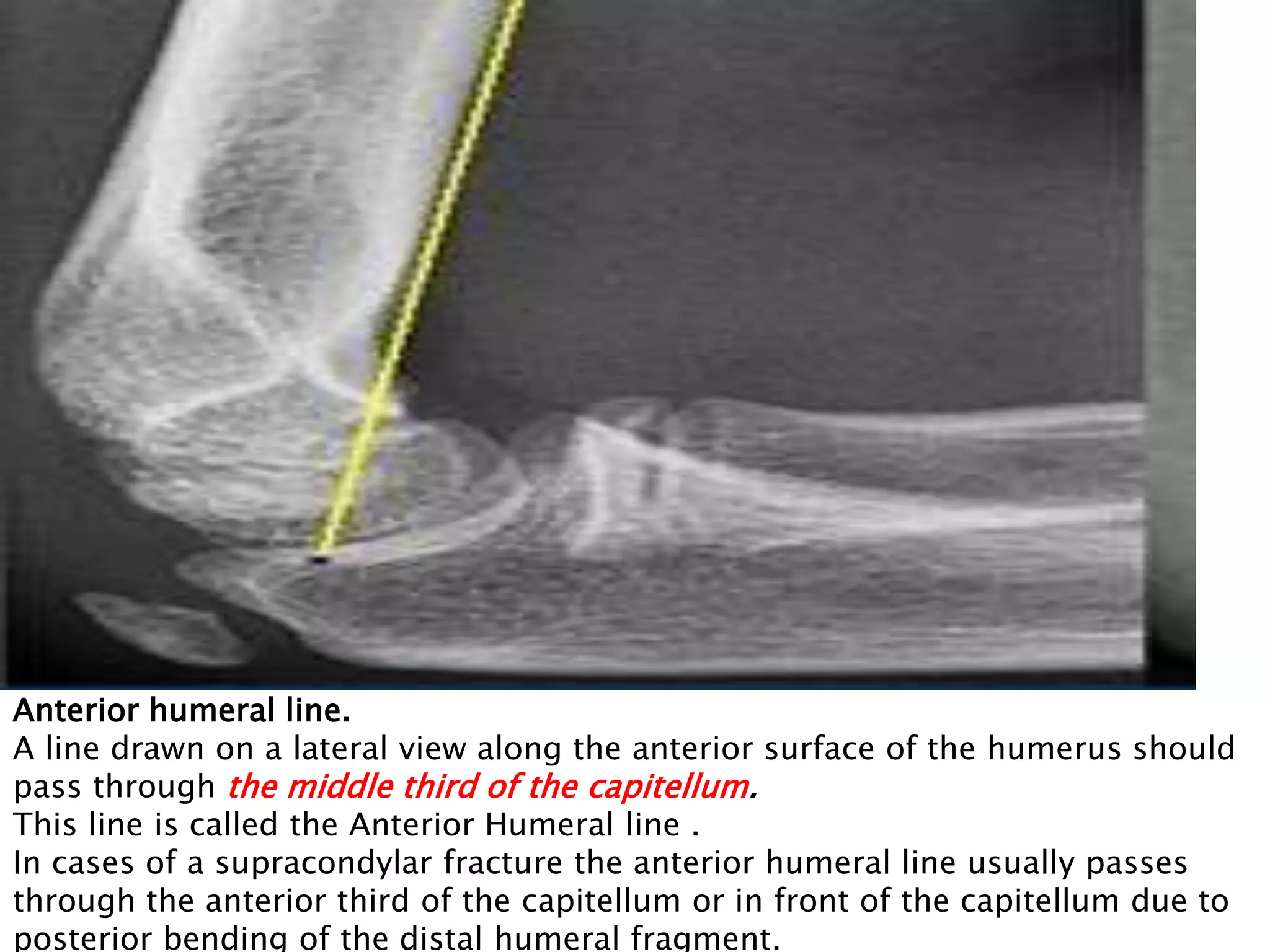 Fractures of the distal humerus ppt | PPTX