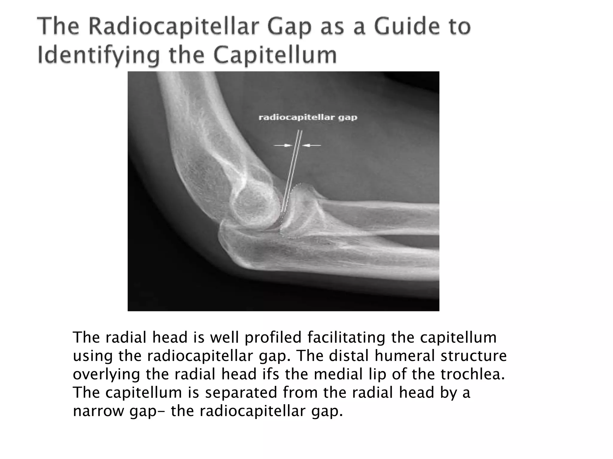 Fractures of the distal humerus ppt | PPTX