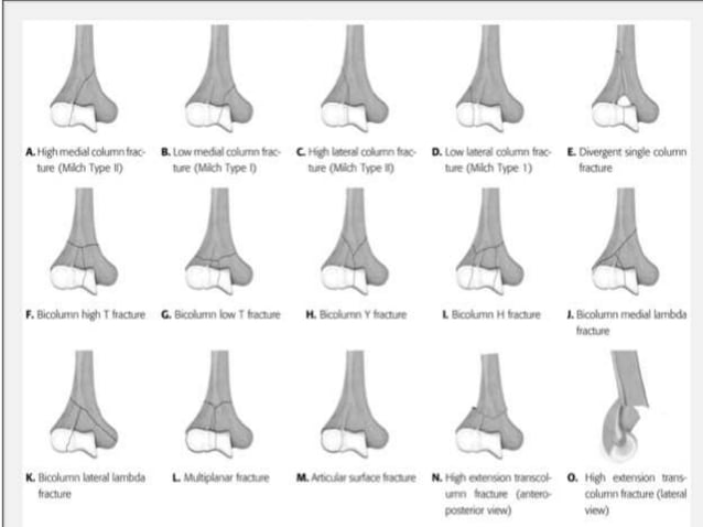 Fractures of the distal humerus ppt | PPTX | Death, Injury, or Military ...