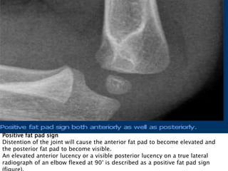 Fractures of the distal humerus ppt | PPTX