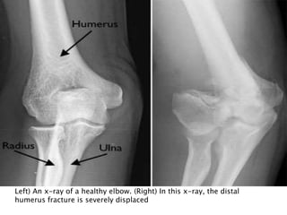 Fractures of the distal humerus ppt | PPTX