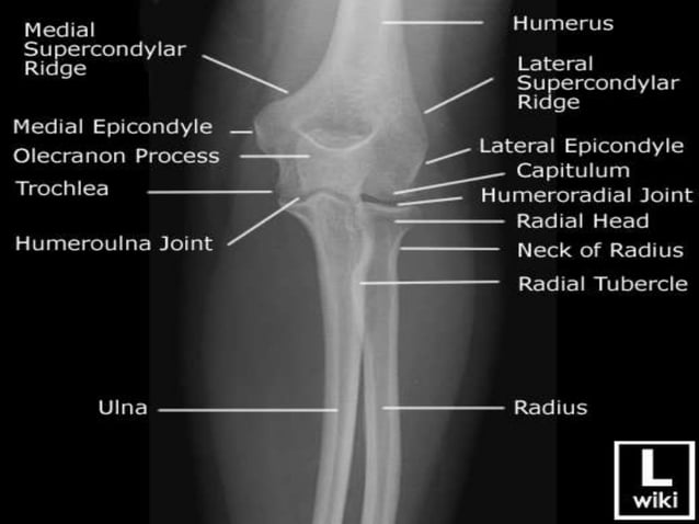 Fractures of the distal humerus ppt | PPTX | Death, Injury, or Military ...