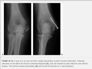 Fractures of the distal humerus ppt | PPTX
