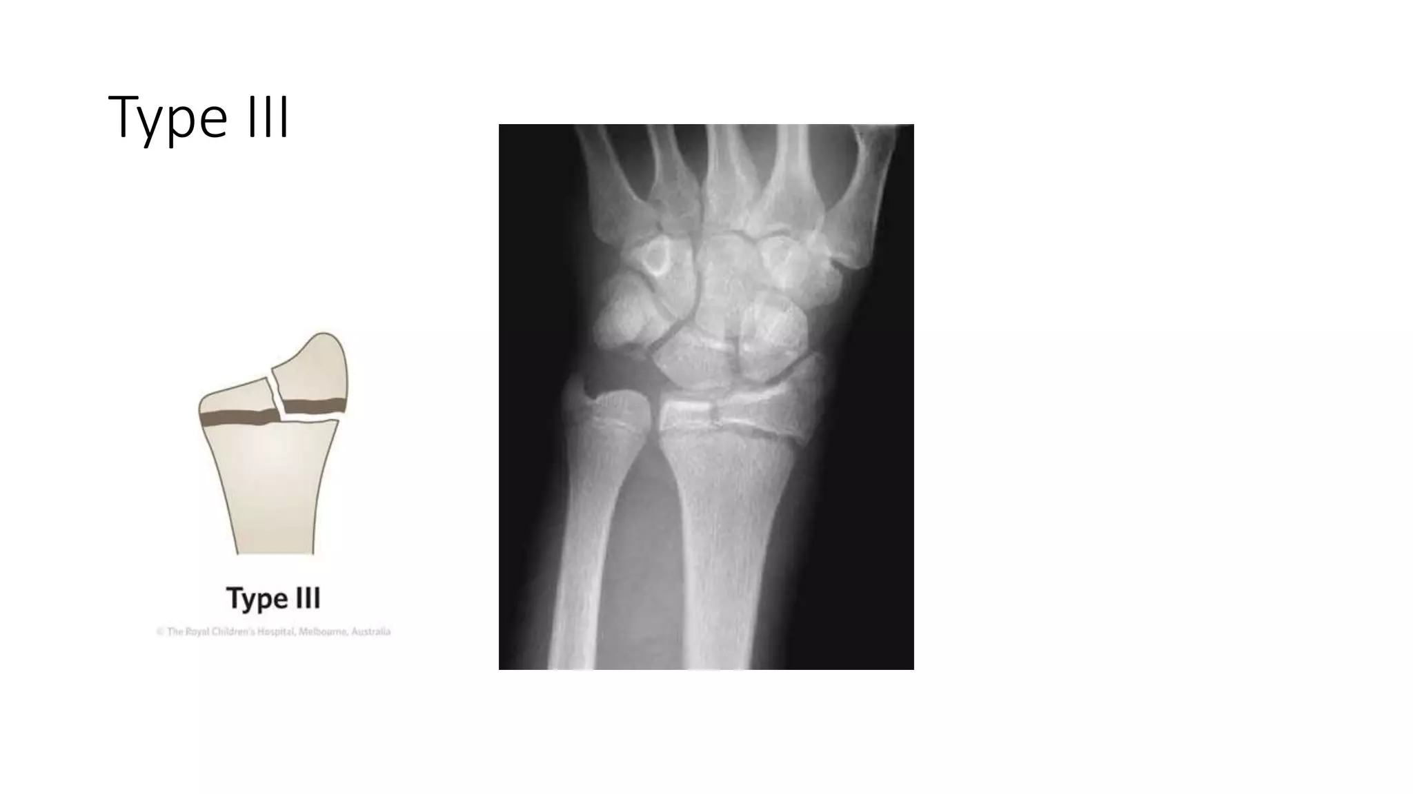 Fractures of the distal radial physis and barton's fracture | PPTX