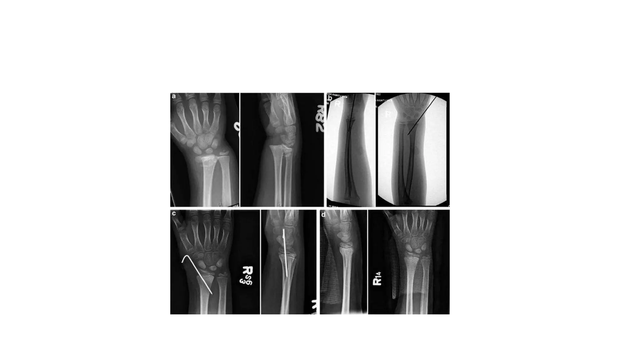 Fractures of the distal radial physis and barton's fracture | PPTX