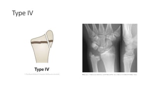 Fractures of the distal radial physis and barton's fracture | PPTX