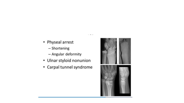 Fractures of the distal radial physis and barton's fracture | PPTX ...
