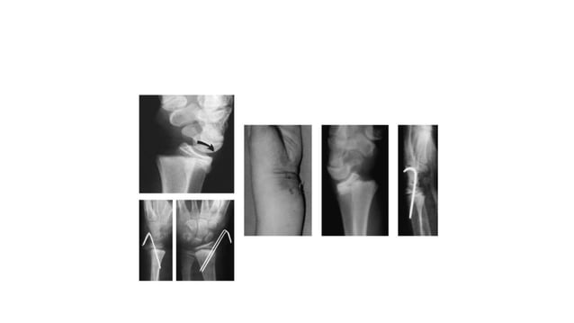 Fractures of the distal radial physis and barton's fracture | PPTX ...