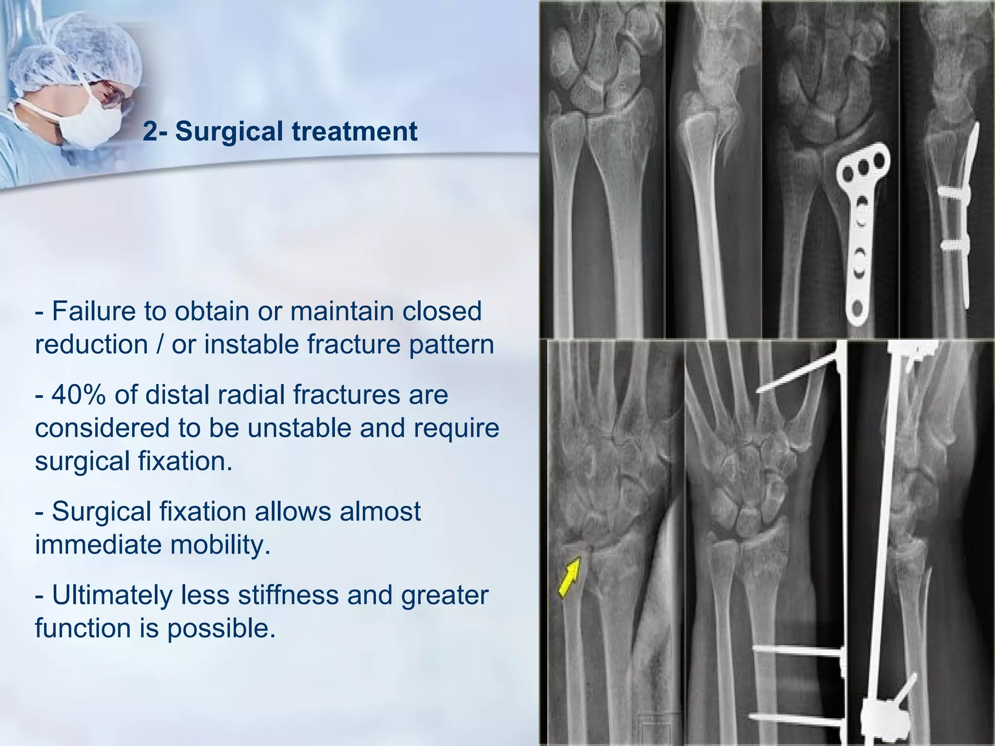 Fractures Of The Distal Radius | PPT