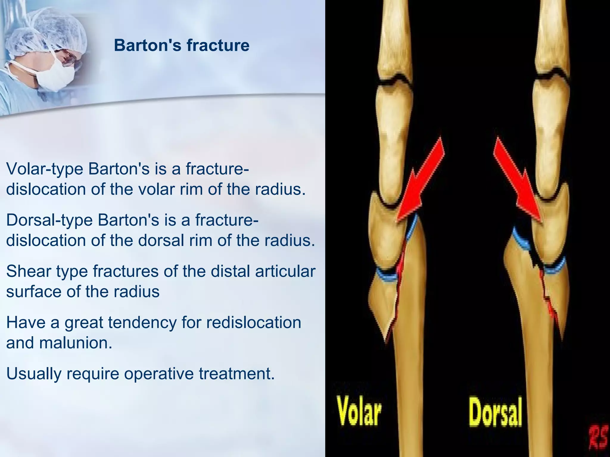 Fractures Of The Distal Radius | PPT