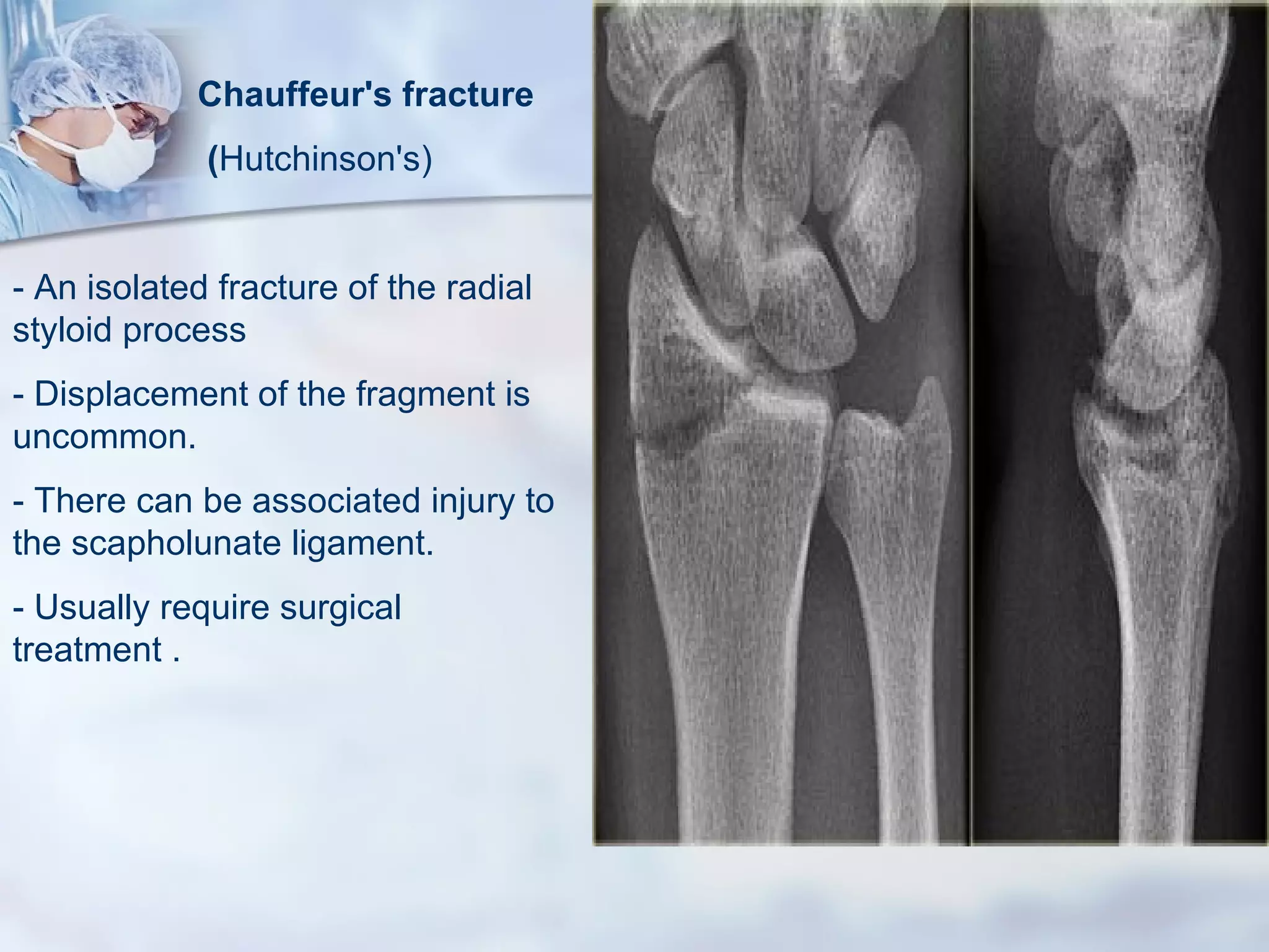 Fractures Of The Distal Radius | PPT