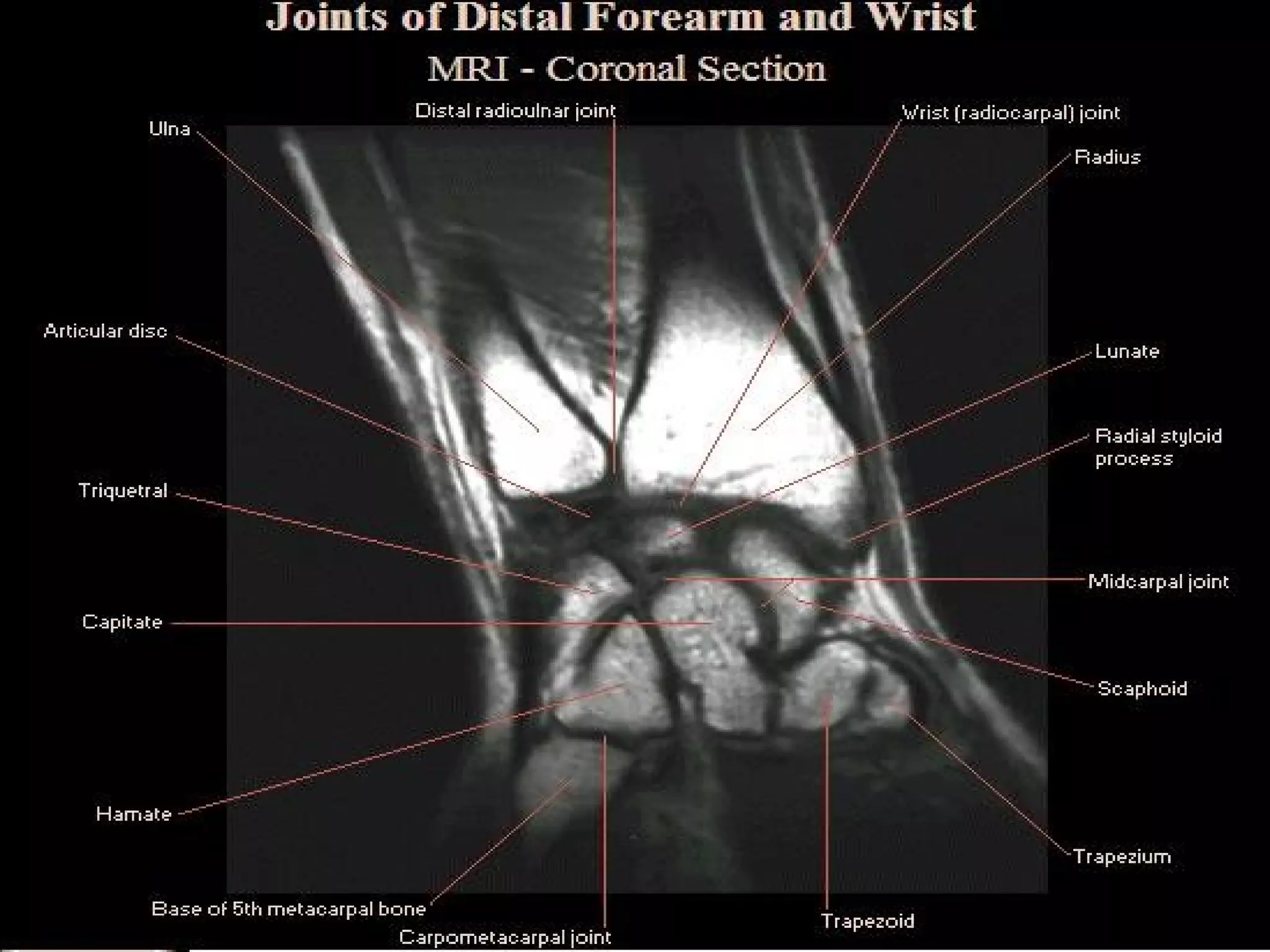 Fractures Of The Distal Radius | PPT
