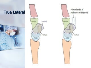 Fractures Of The Distal Radius | PPT