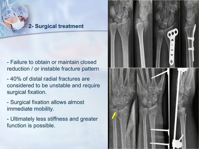 Fractures Of The Distal Radius | PPT