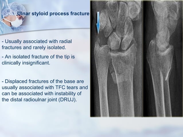 Fractures Of The Distal Radius | PPT