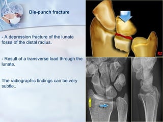 Die Punch Fracture