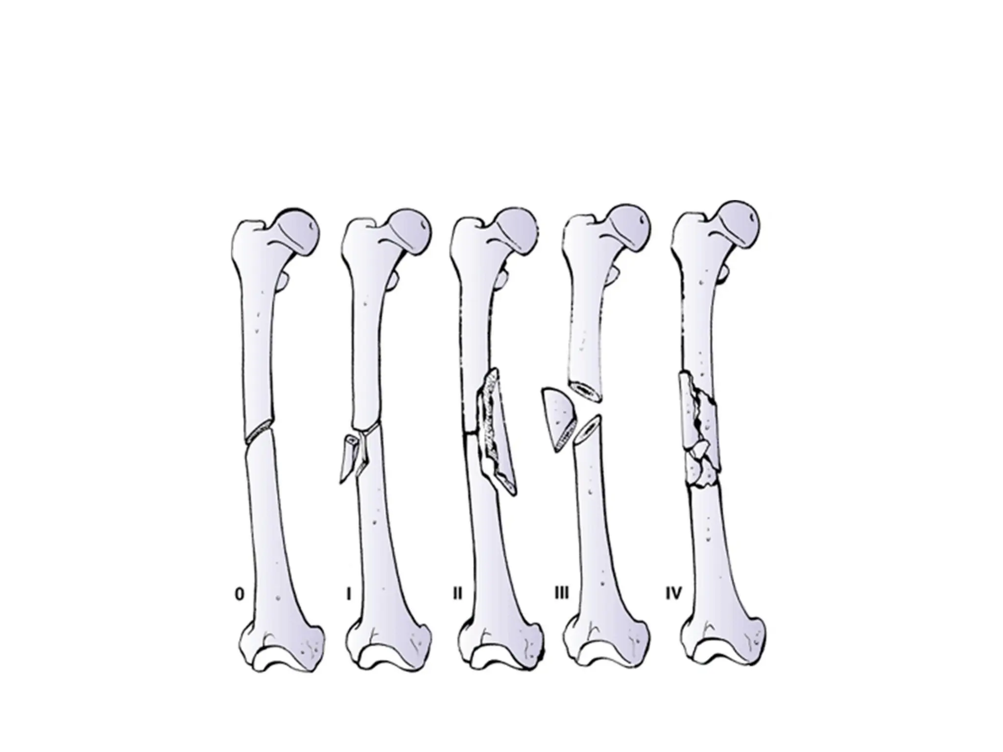 most common Fractures of the Femur .pptx