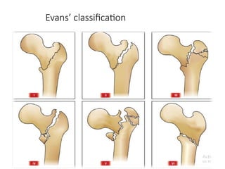 most common Fractures of the Femur .pptx