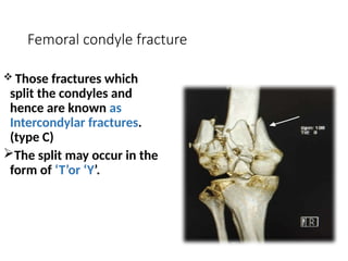 most common Fractures of the Femur .pptx
