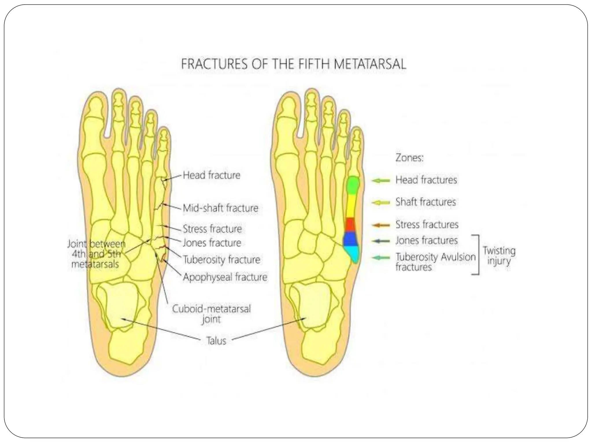 FRACTURES OF THE FIFTH METATARSAL BASE – JONES.pptx