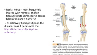 Fractures of the humeral shaft with radial nerve | PPT