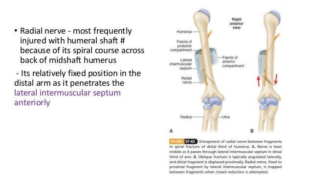 Fractures of the humeral shaft with radial nerve