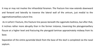 Fractures of the Middle-third of the Facial Skeleton (1).pptx
