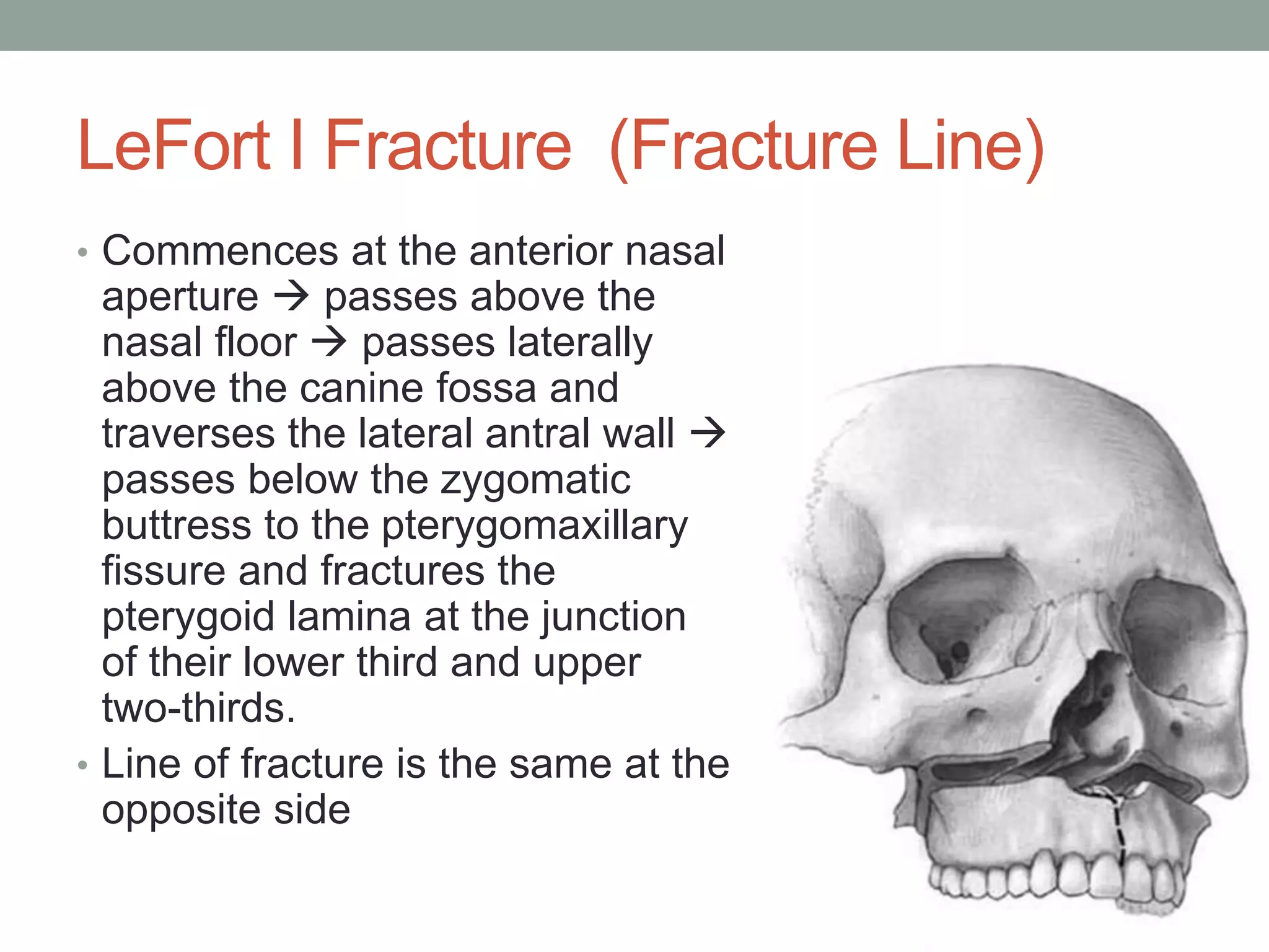 Fractures of the Middle third of the Facial Skeleton | PPTX