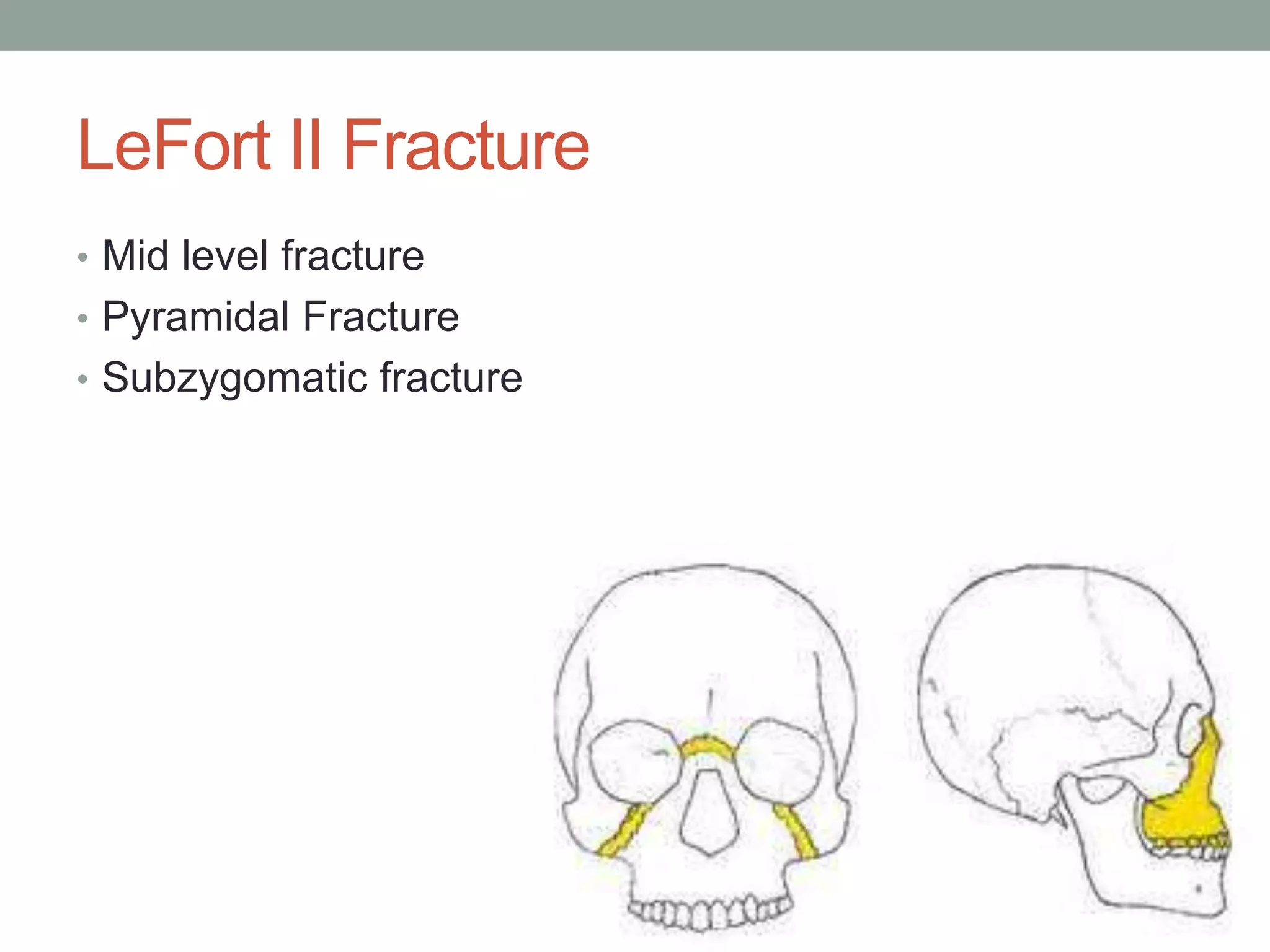 Fractures of the Middle third of the Facial Skeleton | PPTX