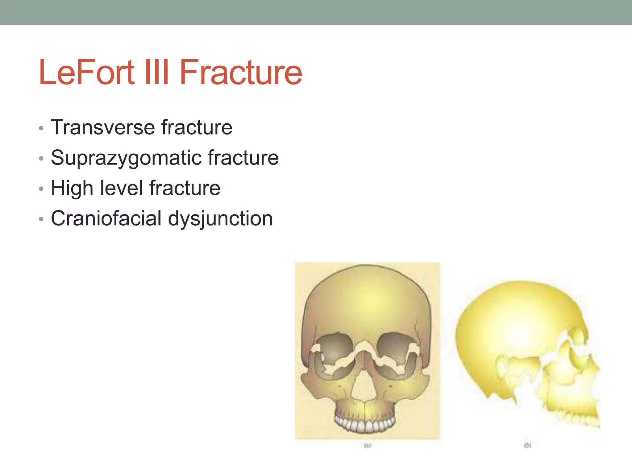 Fractures of the Middle third of the Facial Skeleton | PPTX