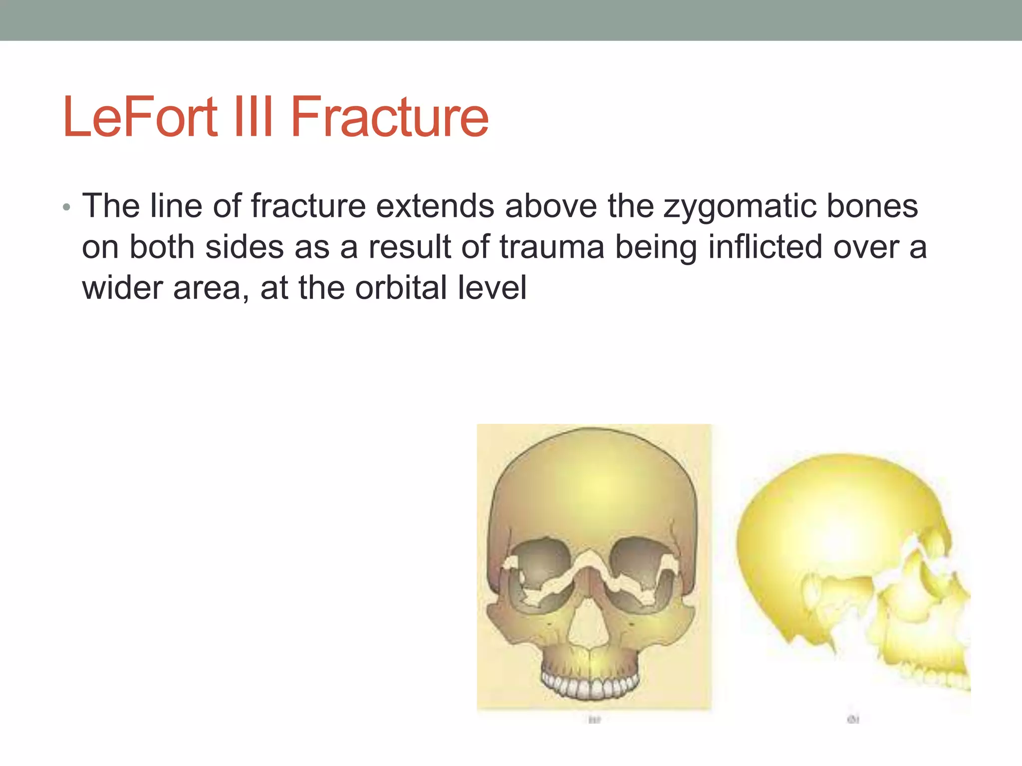 Fractures of the Middle third of the Facial Skeleton | PPTX