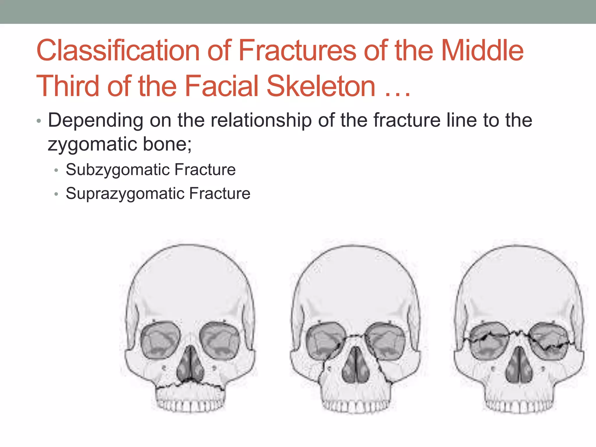 Fractures of the Middle third of the Facial Skeleton | PPTX