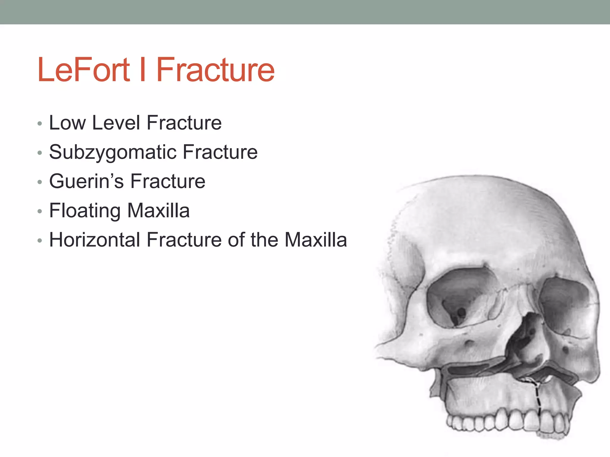 Fractures of the Middle third of the Facial Skeleton | PPTX