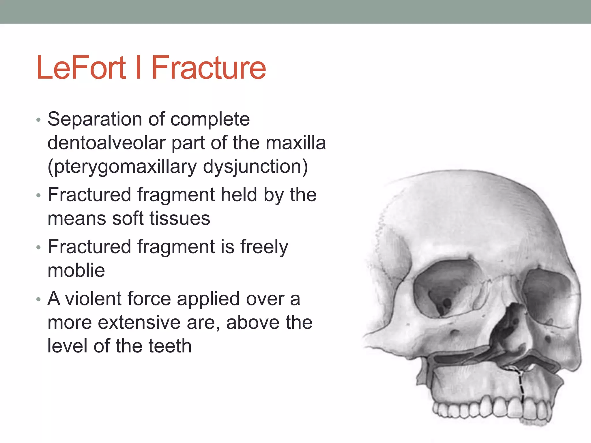 Fractures of the Middle third of the Facial Skeleton | PPTX