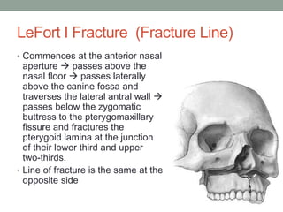 Fractures of the Middle third of the Facial Skeleton | PPTX