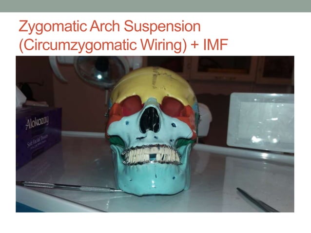 Fractures of the Middle third of the Facial Skeleton | PPTX