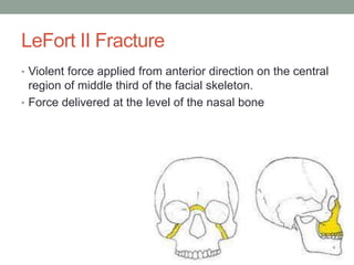 Fractures of the Middle third of the Facial Skeleton | PPTX