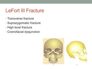 Fractures of the Middle third of the Facial Skeleton | PPTX