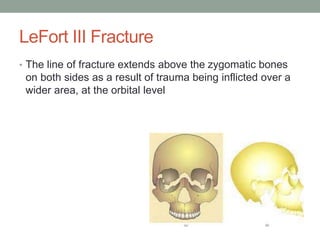 Fractures of the Middle third of the Facial Skeleton | PPTX