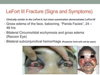 Fractures of the Middle third of the Facial Skeleton | PPTX