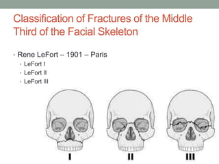 Fractures of the Middle third of the Facial Skeleton | PPTX