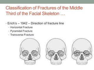 Fractures of the Middle third of the Facial Skeleton | PPTX