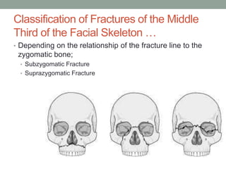 Fractures of the Middle third of the Facial Skeleton | PPTX