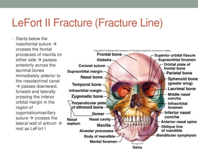 Fractures of the Middle third of the Facial Skeleton