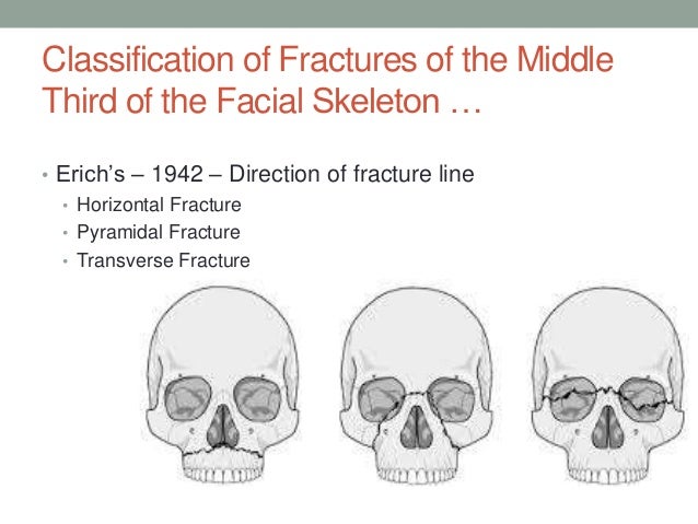 Fractures of the Middle third of the Facial Skeleton