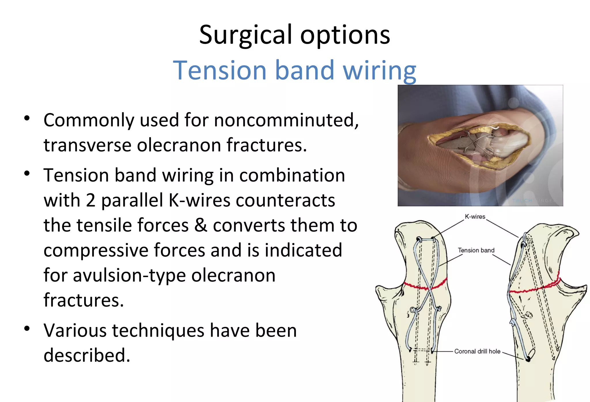 Fractures of the olecranon | PPT