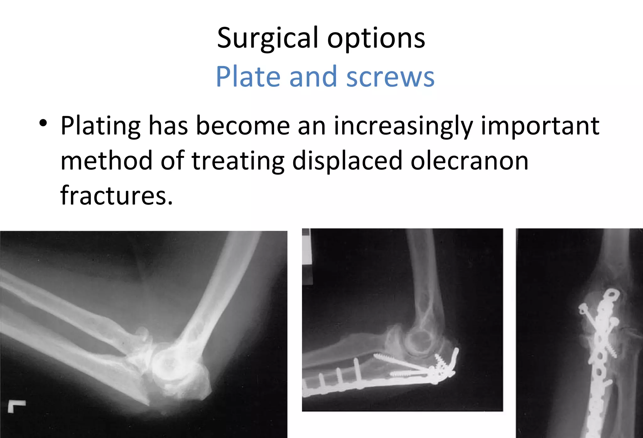 Fractures of the olecranon | PPT