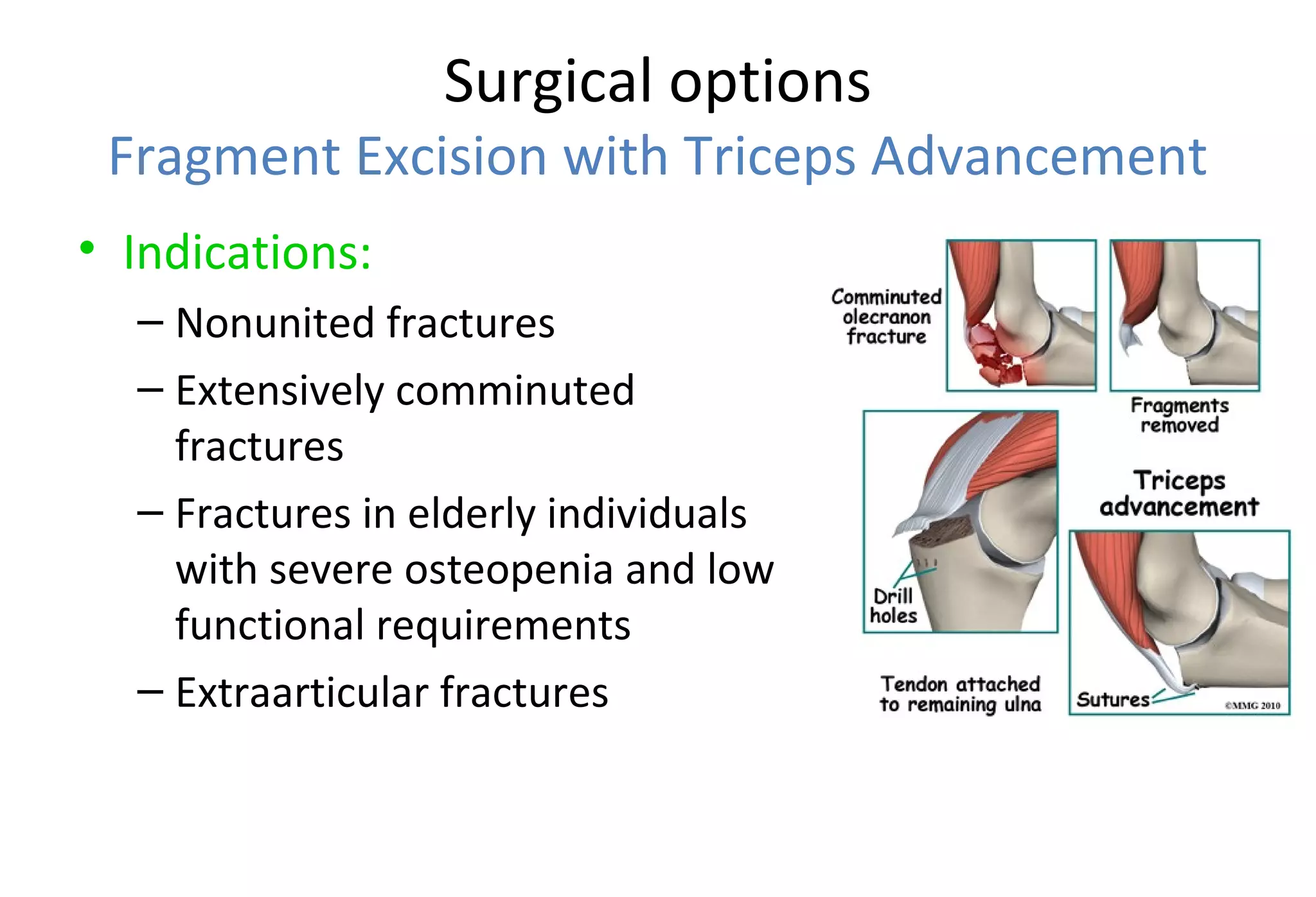 Fractures of the olecranon | PPT