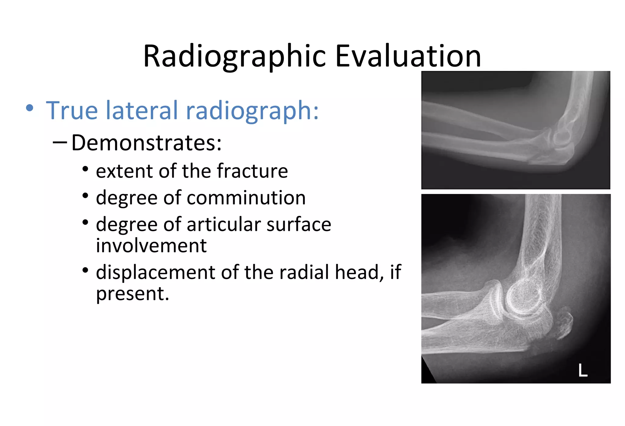 Fractures of the olecranon | PPT